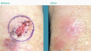 Non-Surgical Skin Cancer Treatment - Associated Dermatology & Skin ...